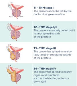 Stages of Prostate Cancer | PCFA