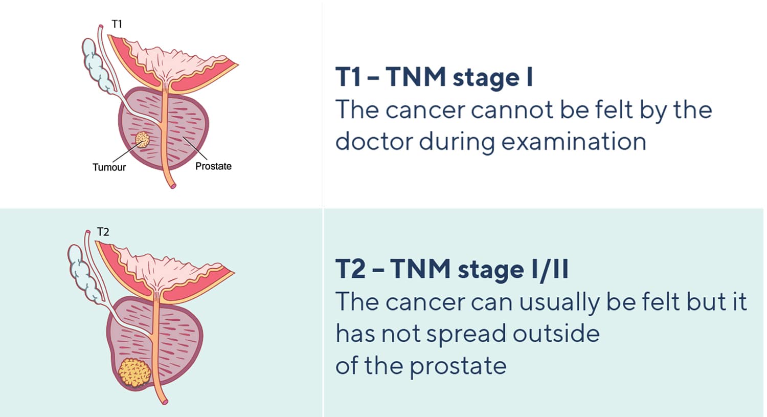 Types of Advanced Prostate Cancer | PCFA