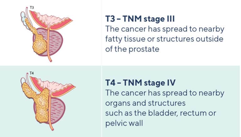 Types of Advanced Prostate Cancer | PCFA